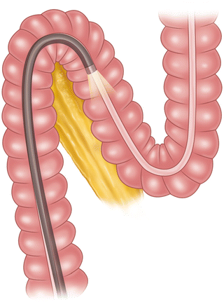 Anatomic Basis of Colonoscopy | SpringerLink