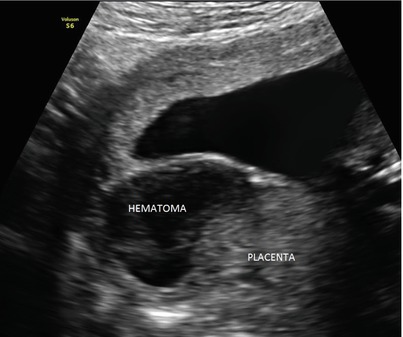 Abruptio Placenta | SpringerLink