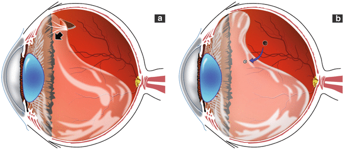 Peripheral Retinal Degenerations as a Risk Factor for Rhegmatogenous ...