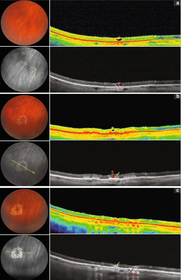 Retinal Laser Photocoagulation in Peripheral Retinal Degenerations ...