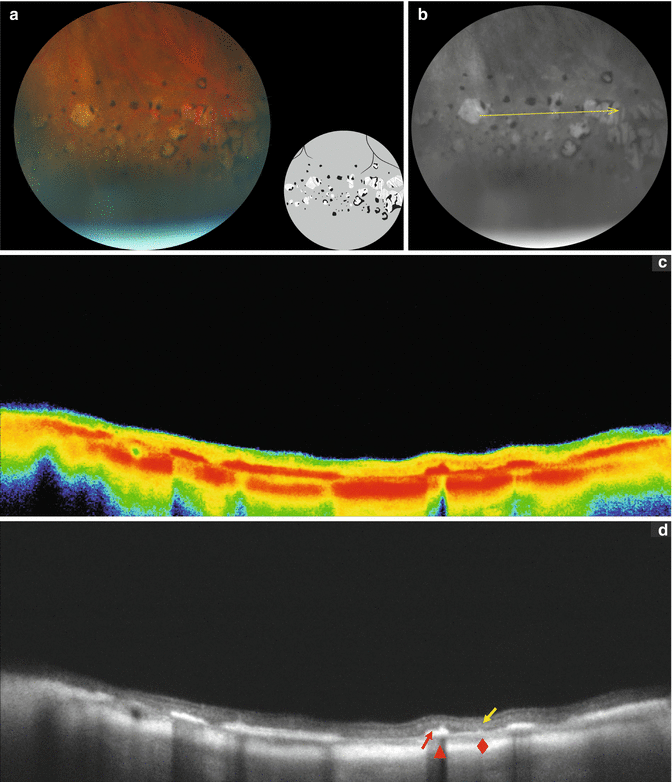 Retinal Laser Photocoagulation in Peripheral Retinal Degenerations ...