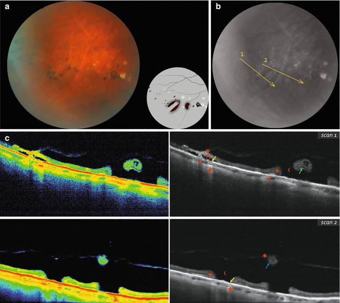 Retinal Laser Photocoagulation in Peripheral Retinal Degenerations ...