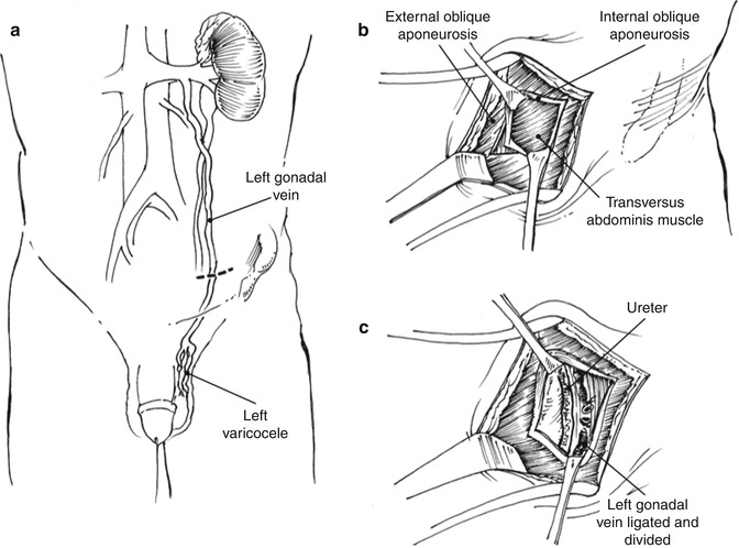 Surgical Treatment Of Varicocele Springerlink