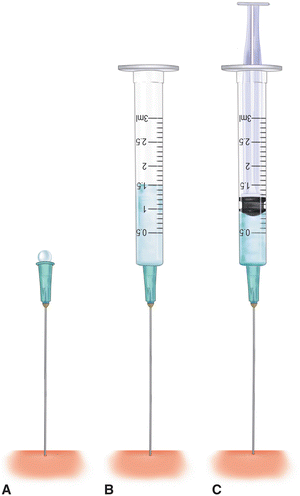 Complications of Thoracic Wall Regional Anesthesia and Analgesia ...