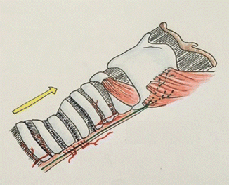 Step-by-Step Tracheal Resection with End-to-End Anastomosis | SpringerLink