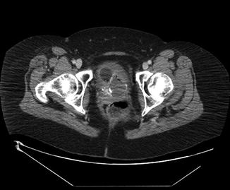 Periurethral Bulking Agent Injection in the Treatment of Female Stress ...