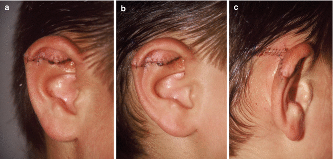 Traumatic Amputation of the Ear: What to Do with the Amputated Segment ...