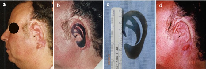 Traumatic Amputation of the Ear: What to Do with the Amputated Segment ...