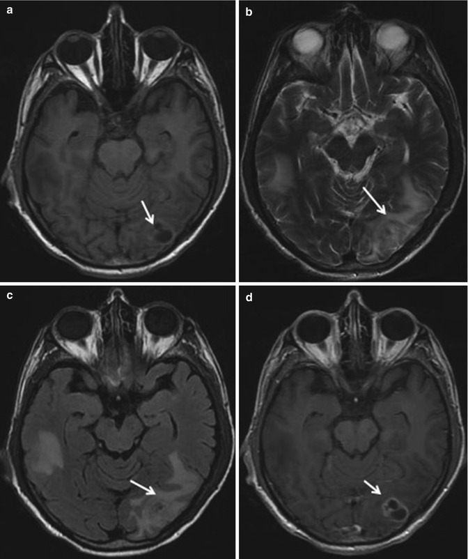 Pathology of Tuberculosis of the Nervous System (Tuberculous Meningitis ...