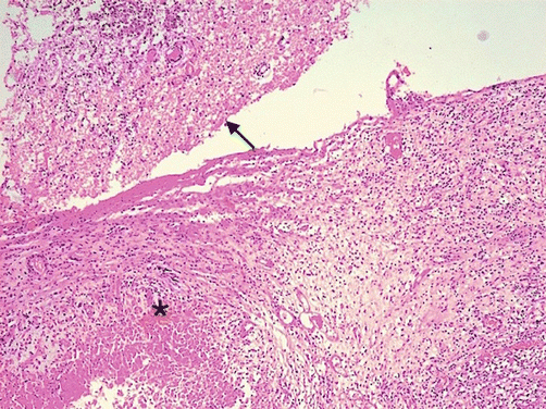 Pathology of Tuberculosis of the Nervous System (Tuberculous Meningitis ...