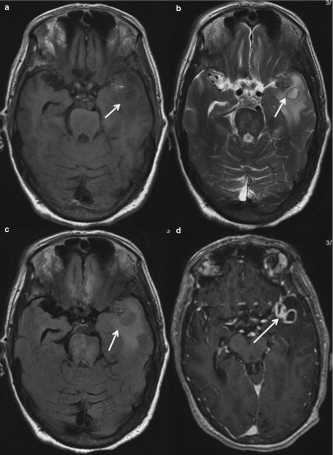 Pathology of Tuberculosis of the Nervous System (Tuberculous Meningitis ...