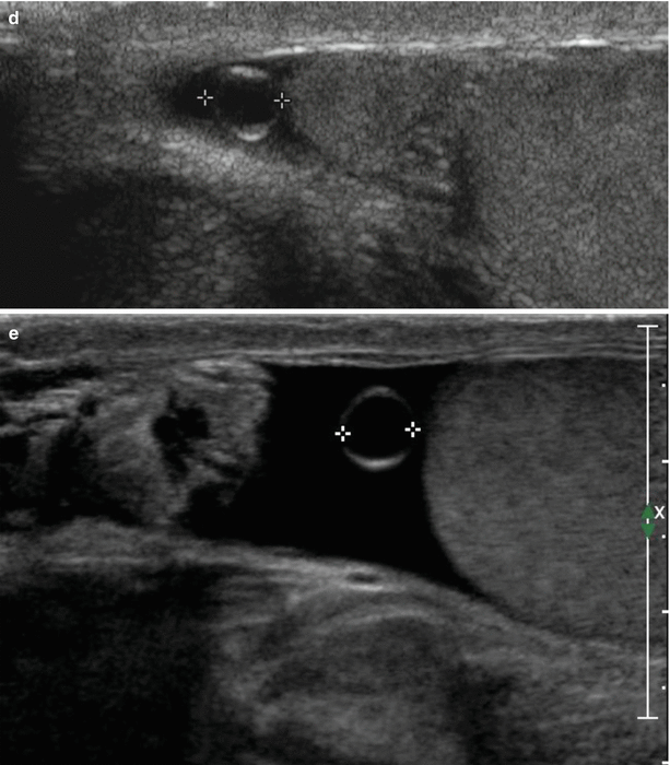 Scrotal and Testicular Anatomy | SpringerLink