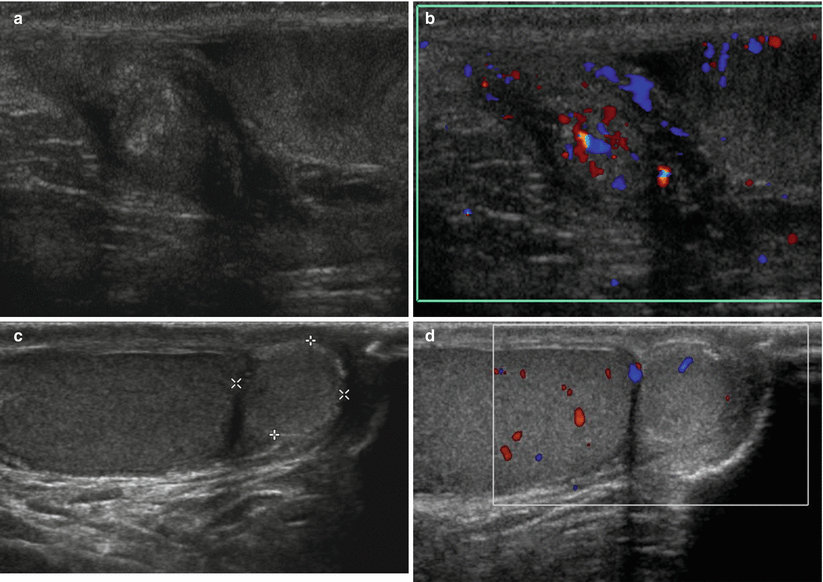 Extratesticular Lesions | SpringerLink