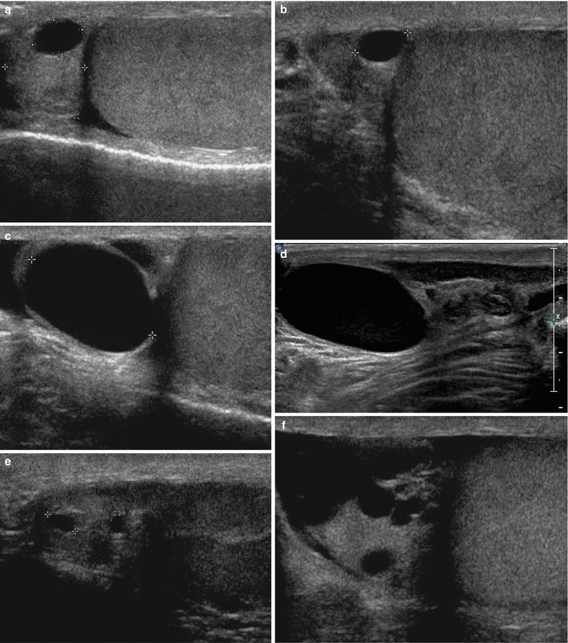 Extratesticular Lesions | SpringerLink