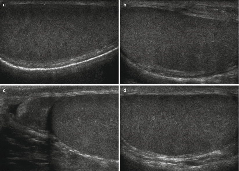 Extratesticular Lesions | SpringerLink