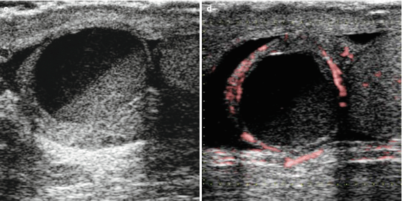 Extratesticular Lesions | SpringerLink