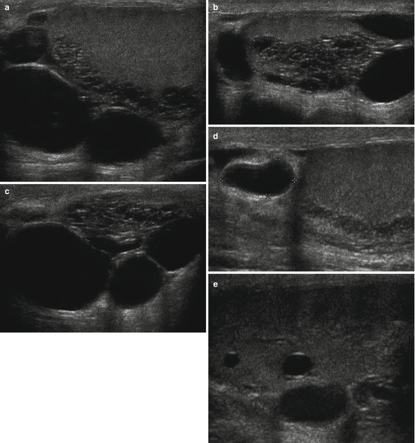Extratesticular Lesions | SpringerLink