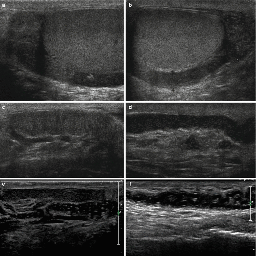 Extratesticular Lesions | SpringerLink