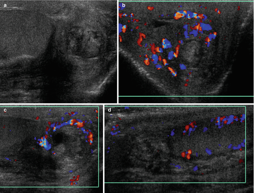 Extratesticular Lesions | SpringerLink