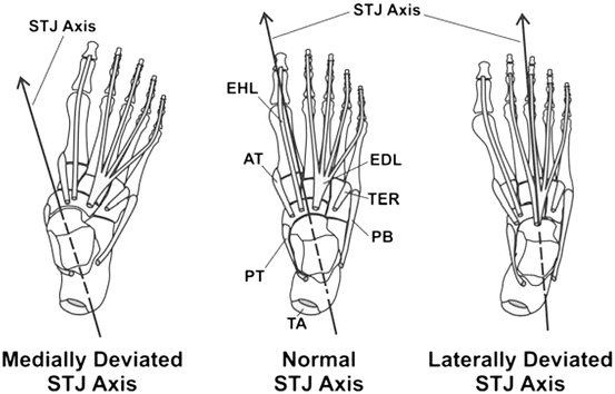 Evolution of Foot Orthoses in Sports | SpringerLink