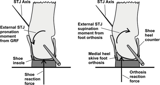 Evolution of Foot Orthoses in Sports | SpringerLink