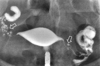 Tubal Disease and Ectopic Pregnancy | SpringerLink