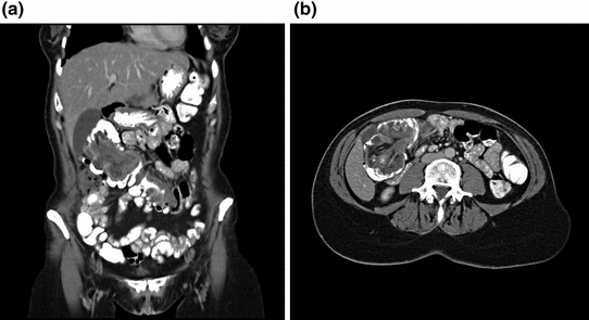 Intussusception | SpringerLink