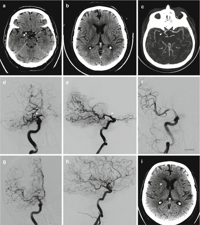 Ischemic Stroke and Homonymous Visual Field Defects | SpringerLink