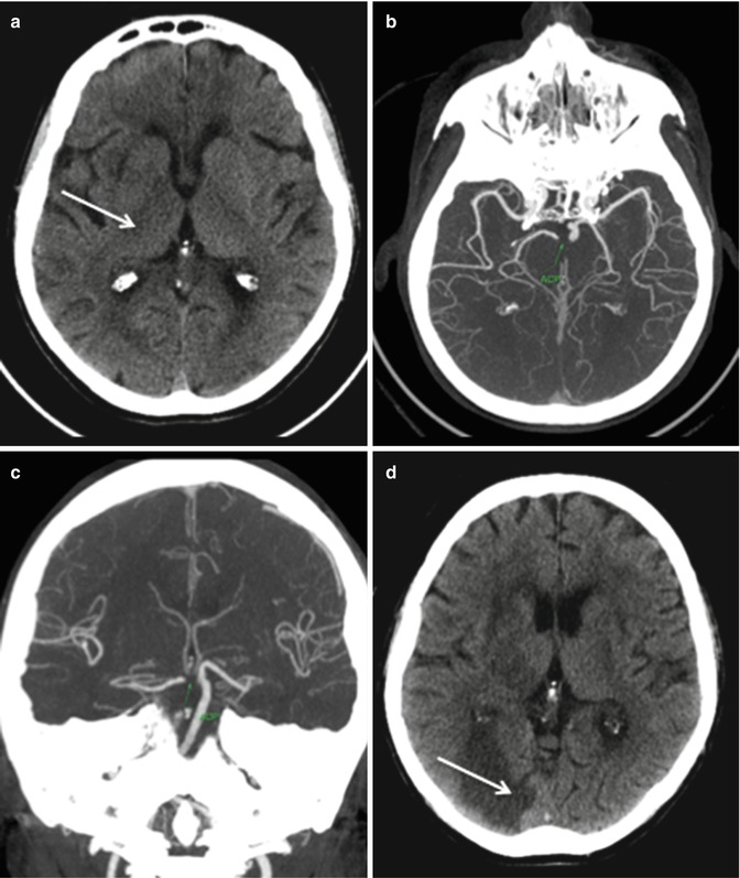 Ischemic Stroke and Homonymous Visual Field Defects | SpringerLink