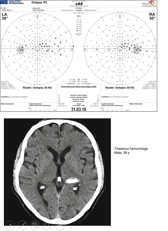 Ischemic Stroke and Homonymous Visual Field Defects | SpringerLink