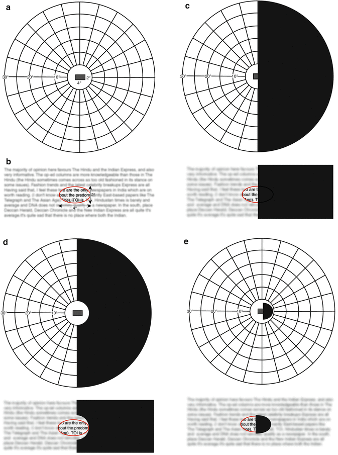 Neuro-Ophthalmological Examination in Homonymous Visual Field Defects ...