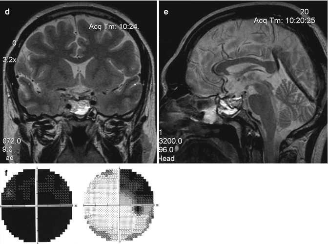 Types of Homonymous Visual Field Defects | SpringerLink
