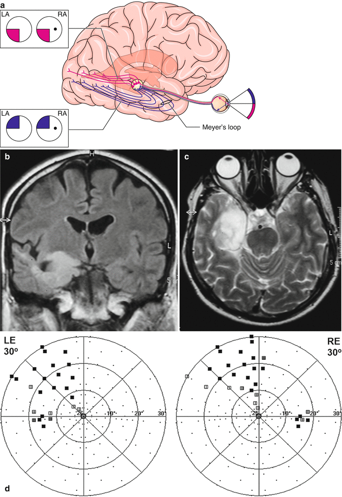 Types of Homonymous Visual Field Defects | SpringerLink