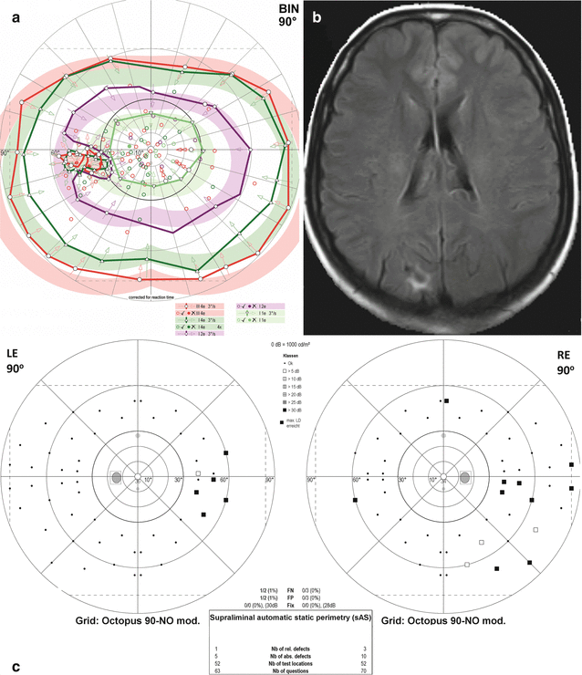 Types of Homonymous Visual Field Defects | SpringerLink