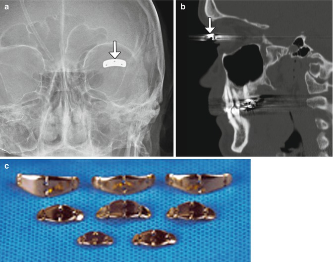 Imaging the Postoperative Orbit | SpringerLink