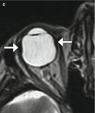 Imaging the Postoperative Orbit | SpringerLink