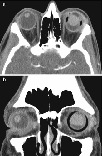Imaging the Postoperative Orbit | SpringerLink
