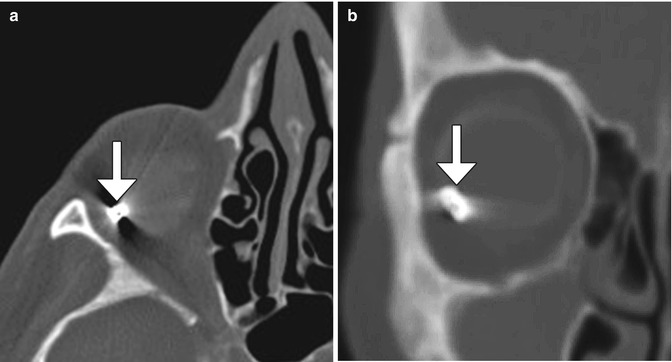 Imaging the Postoperative Orbit | SpringerLink