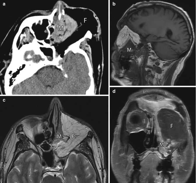 Imaging the Postoperative Orbit | SpringerLink