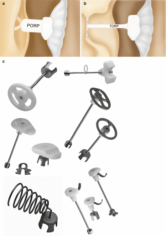 Imaging of the Postoperative Ear and Temporal Bone | SpringerLink
