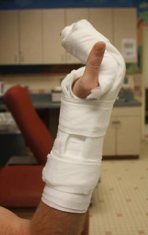 Splinting and Casting Techniques | SpringerLink