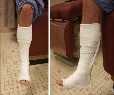 Splinting and Casting Techniques | SpringerLink