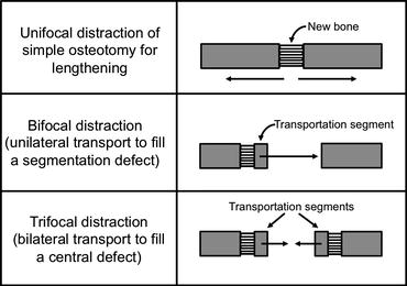 Distraction Osteogenesis: Biologic and Biomechanical Principles | SpringerLink