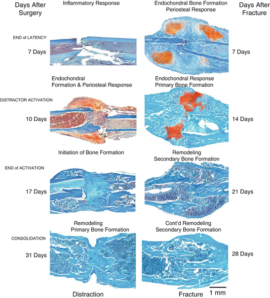 Distraction Osteogenesis: Biologic and Biomechanical Principles ...