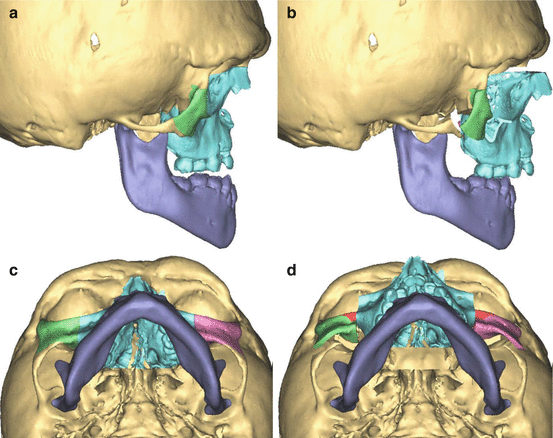 Distraction of the Midface: Le Fort III and Monobloc | SpringerLink