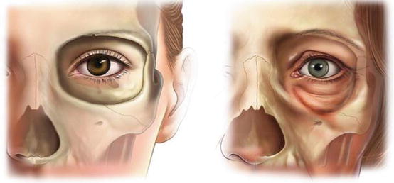 Anatomy of the Periorbital Region | SpringerLink