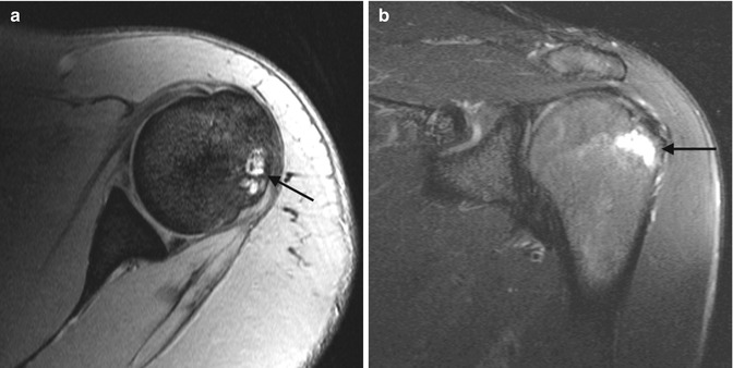 Shoulder Injury: MRI Pitfalls | SpringerLink
