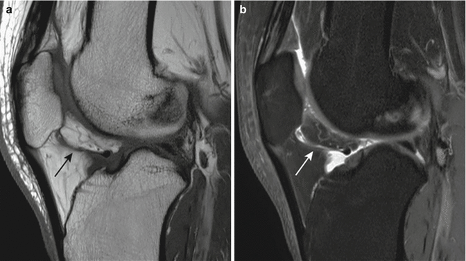 Knee Injury: MRI Pitfalls | SpringerLink