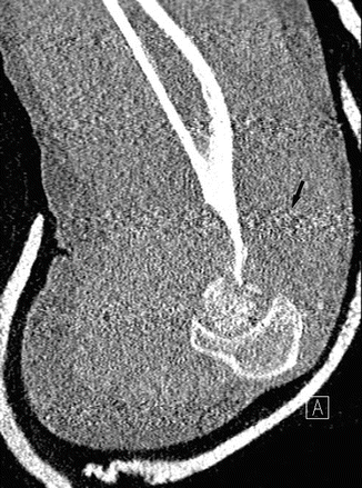 Computed Tomography Artifacts | SpringerLink