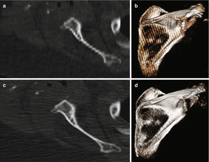 Computed Tomography Artifacts | SpringerLink